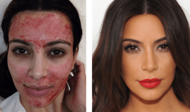 Vampire Facial - La Fameux Derma