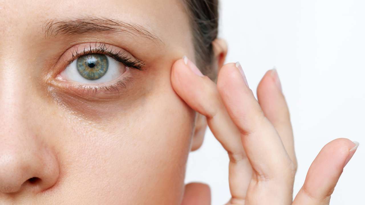 Dark Circles Under Eyes: Causes, Treatments, Results and Prevention ...